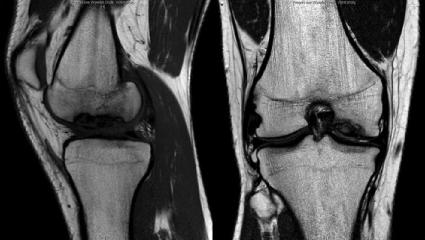 Osteochondrosis Dissecans